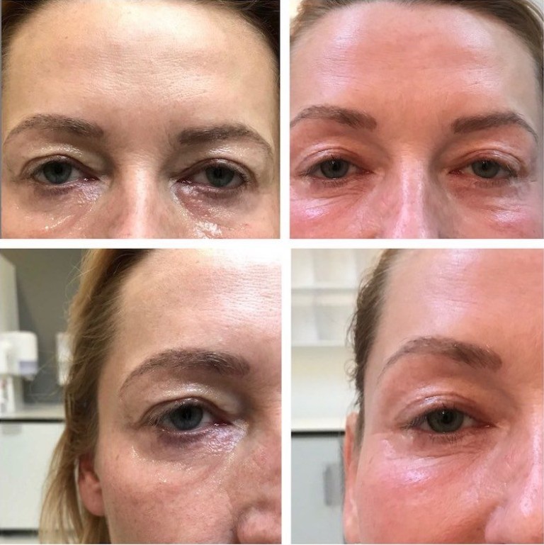 Plasmage behandeling - Easy Cosmetics